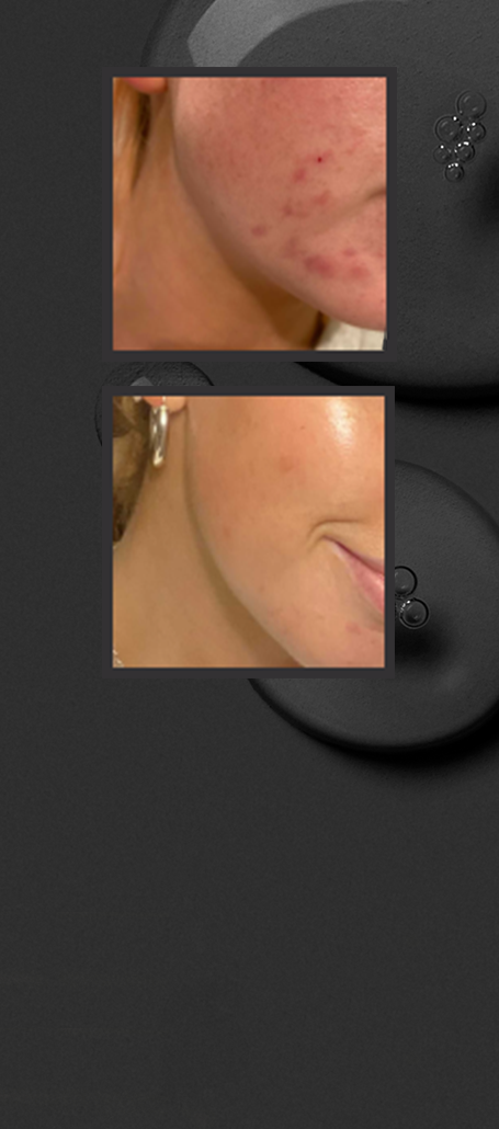 AHA and BHA Exfoliants for All Skin Types | Paula's Choice